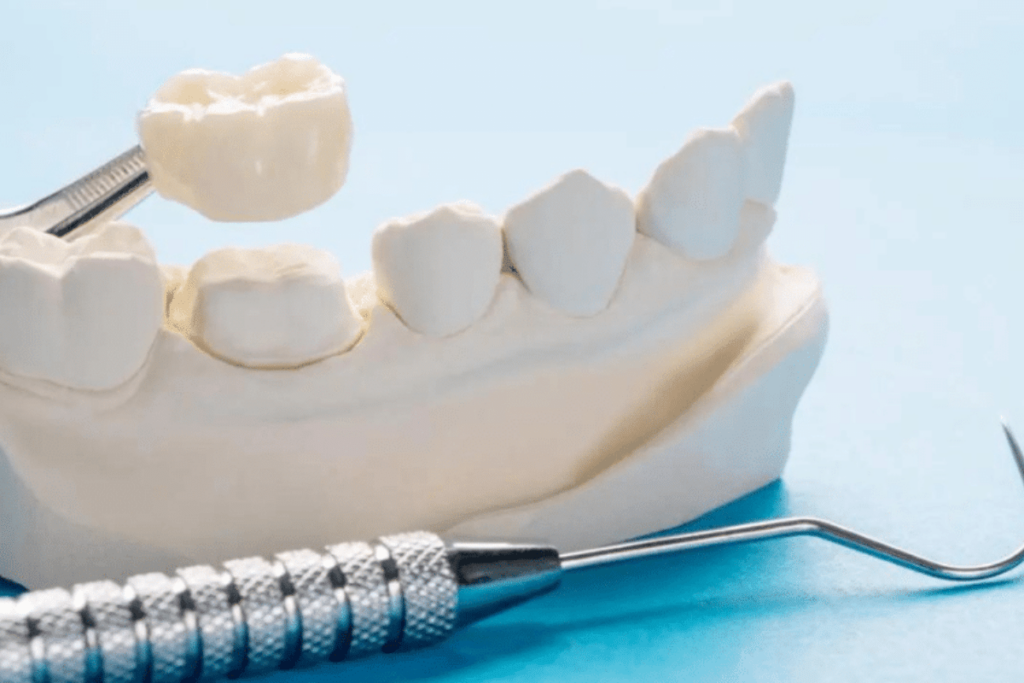 What to Do If Your Dental Crown Breaks: Immediate Steps and ...